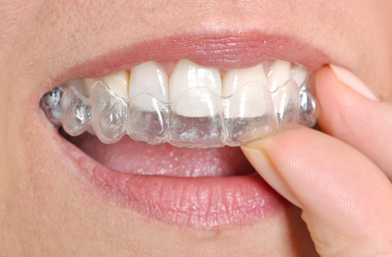 Rehabilitación Oral – RíoSilva Clínica Dental